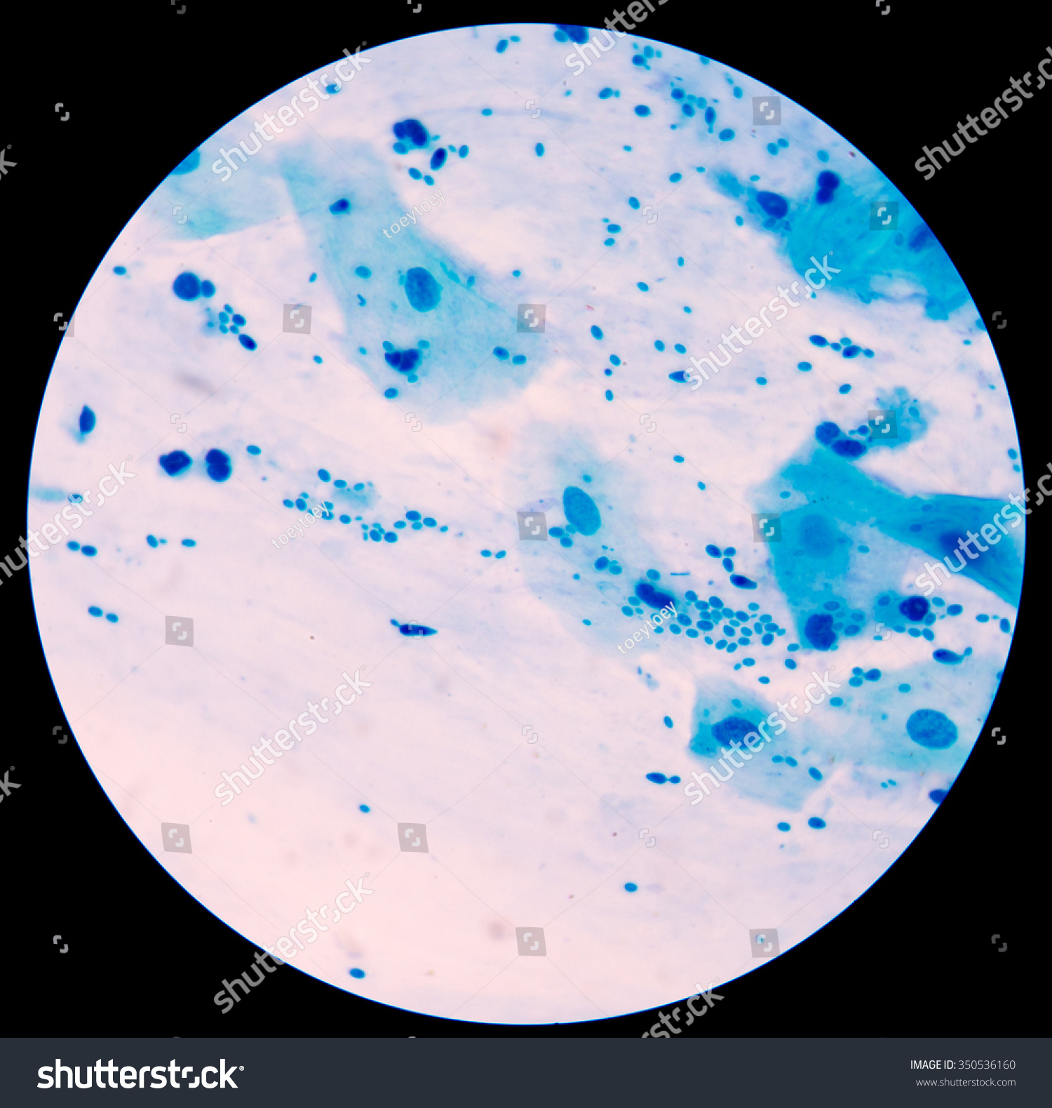 Branching Budding Yeast Cells With Pseudohyphae In Sputum Gram Stain Fine With Microscope Stock