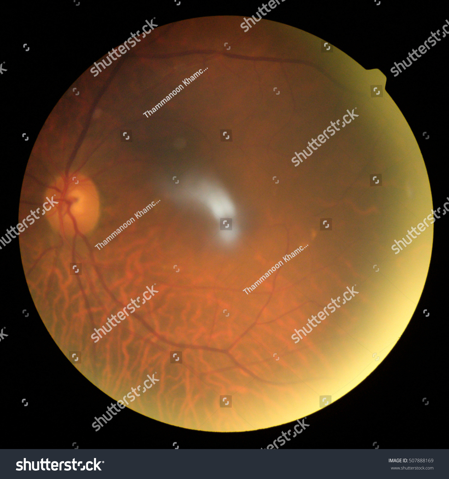 Photo Madical Retina Normal Isolated On Black Backgroundretina Of Diabetes Diabates