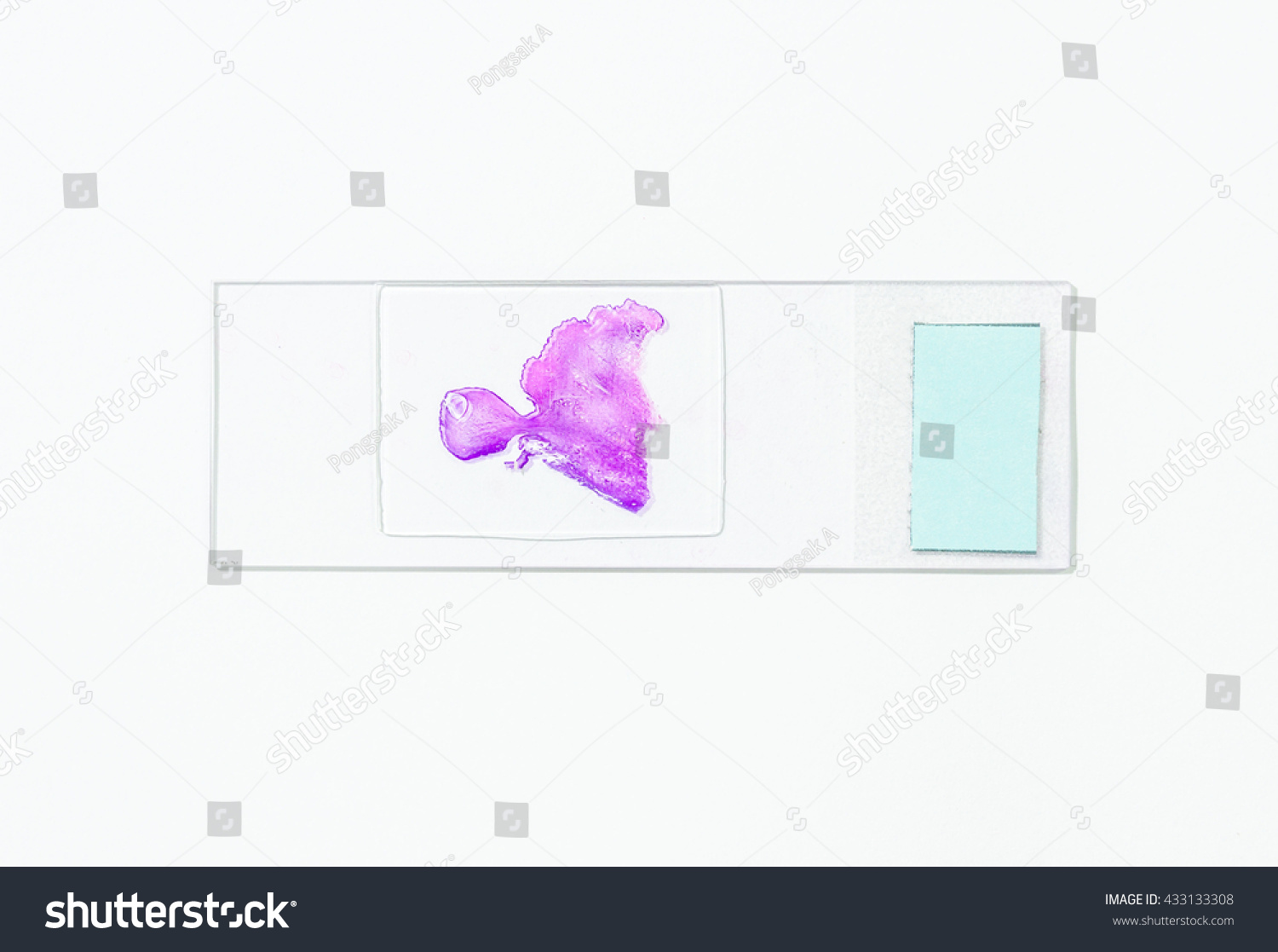 Slide Tissue Biopsy From Uterus With Myoma Or Adenomyosis For Diagnosis In Pathology Laboratory