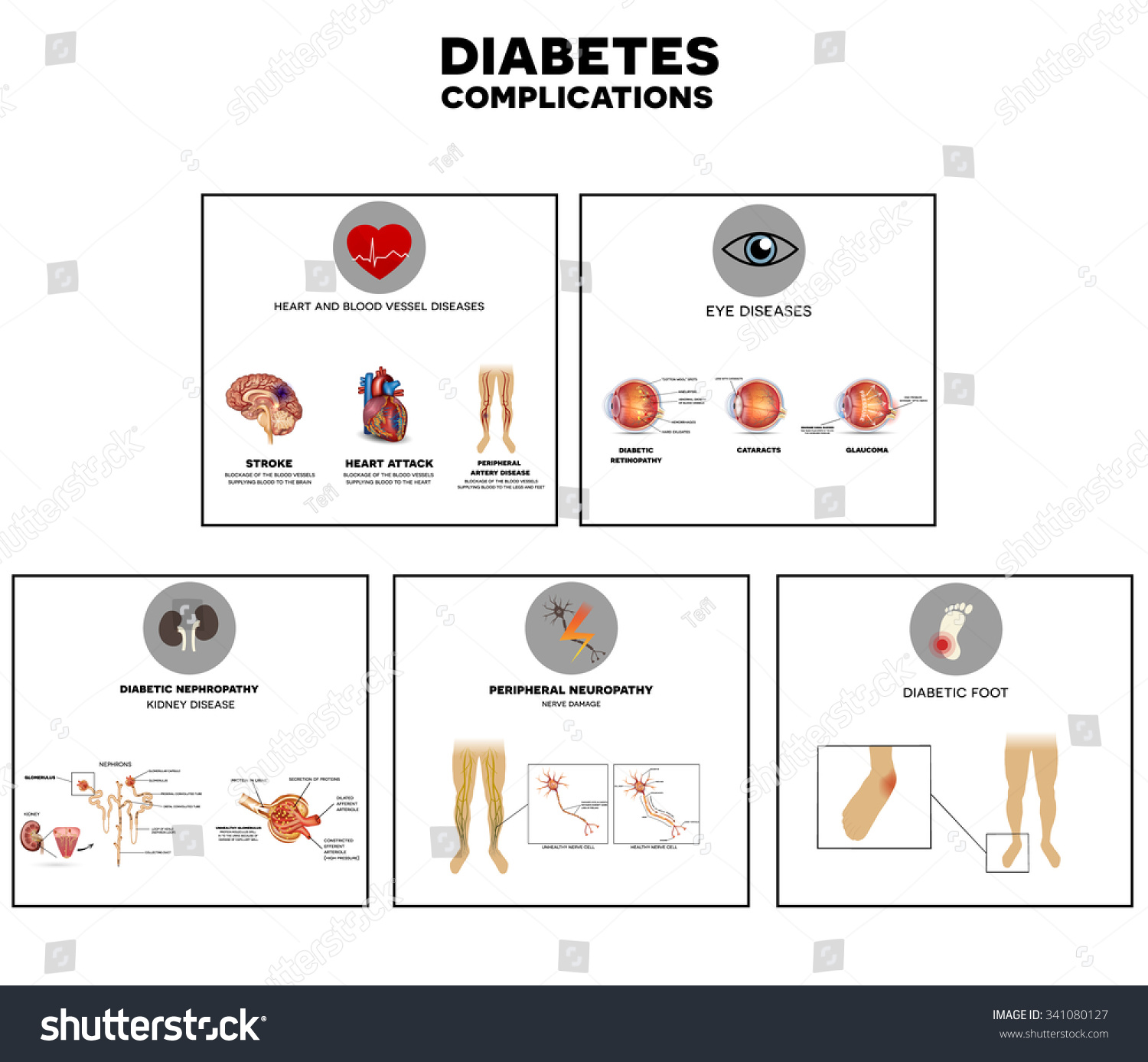 Diabetes Complications Affected Organs Info Graphic Stock Vector ... Diabetes Complications Affected Organs Info Graphic Stock Vector ...