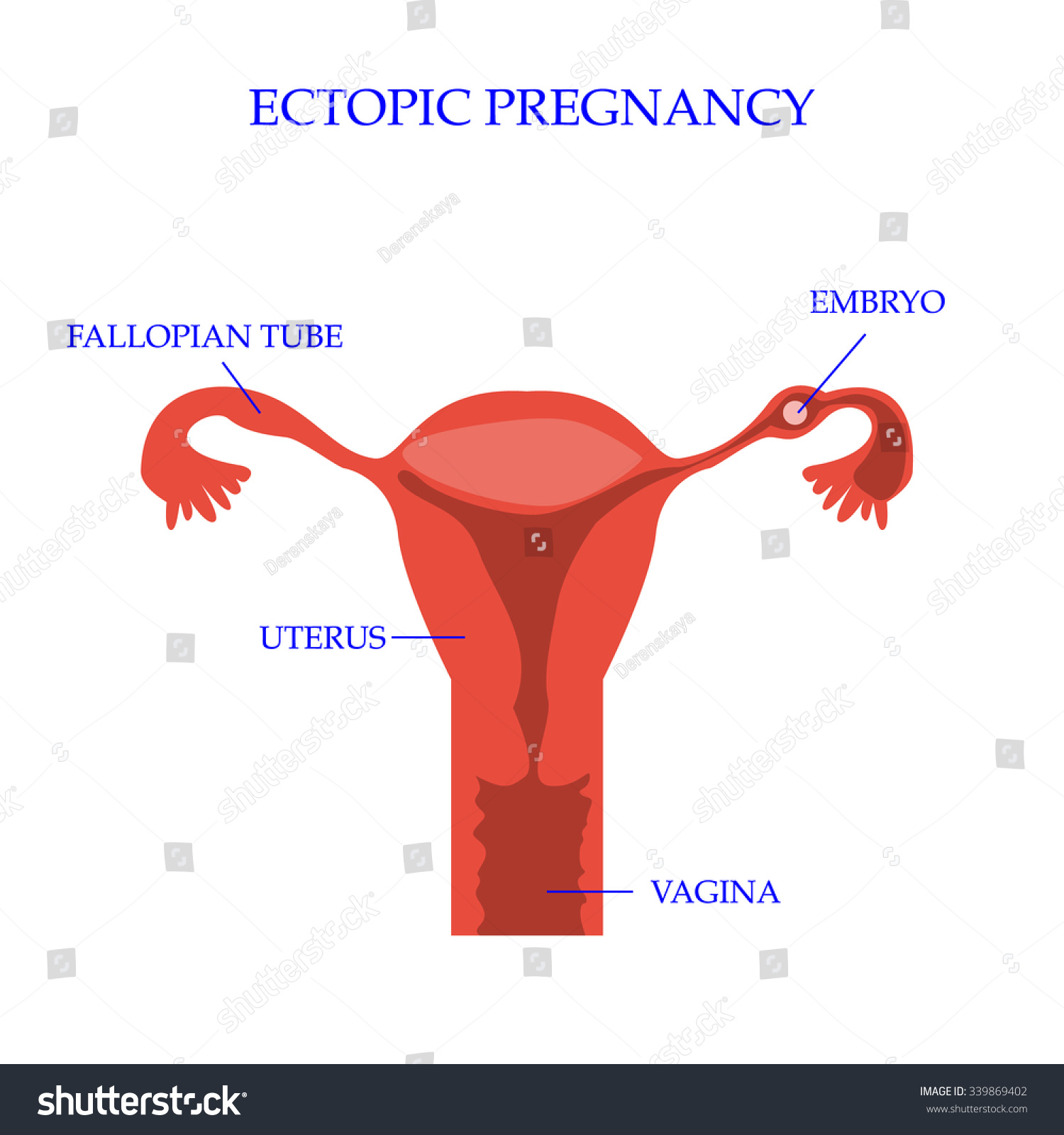 Ectopic Pregnancy Concept Vector Illustration 339869402 Shutterstock