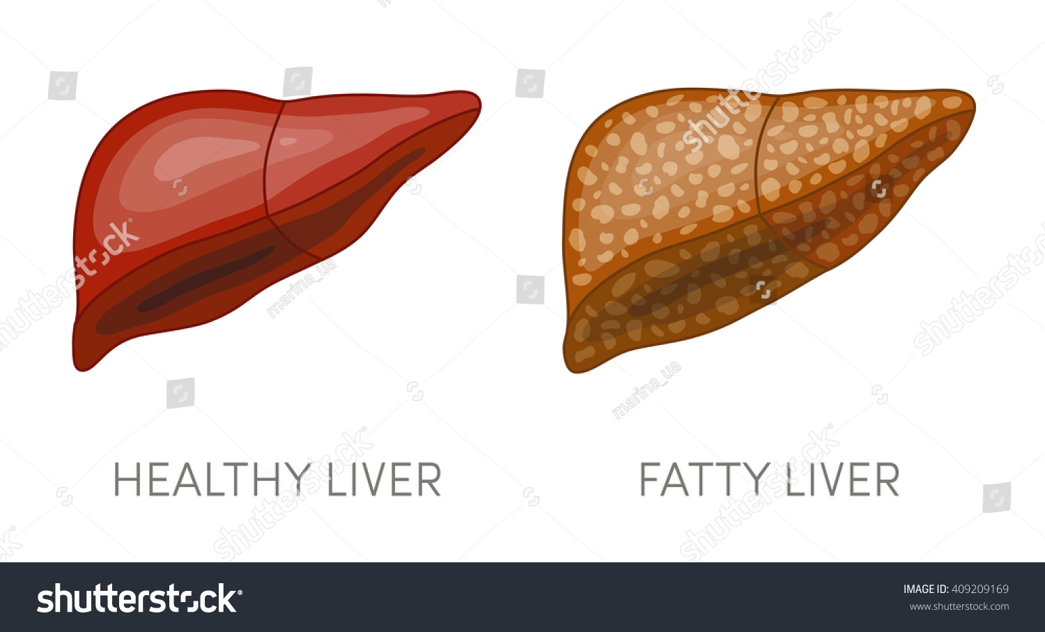 Fatty Liver Disease Vector Illustration Of A Healthy And A Fatty Liver In Cartoon Style