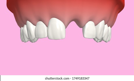 707 Missing Tooth 3d Images, Stock Photos & Vectors | Shutterstock