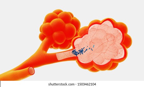 180 Tubercle bacillus Images, Stock Photos & Vectors | Shutterstock