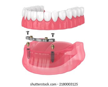274 Fixed Removable Prosthesis Images, Stock Photos & Vectors ...