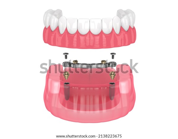 3d Render Bar Retained Removable Overdenture 库存插图 2138223675 | Shutterstock