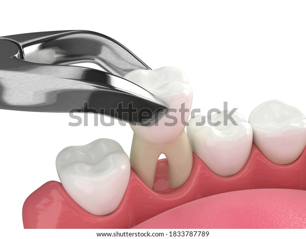 3d Render Lower Jaw Tooth Extracted Stock Illustration 1833787789