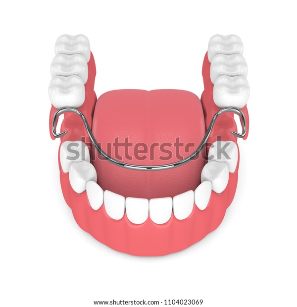 3d Render Removable Partial Denture Isolated Stock Illustration ...