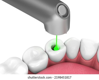 4,180 Decay cleaning Images, Stock Photos & Vectors | Shutterstock