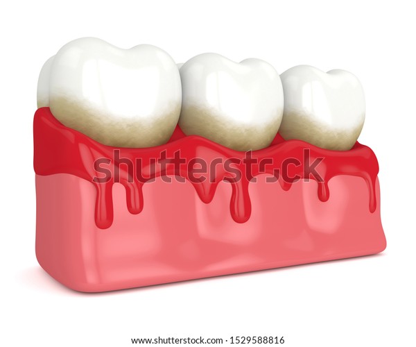 3d Render Teeth Bleeding Gums Over ภาพประกอบสต็อก 1529588816