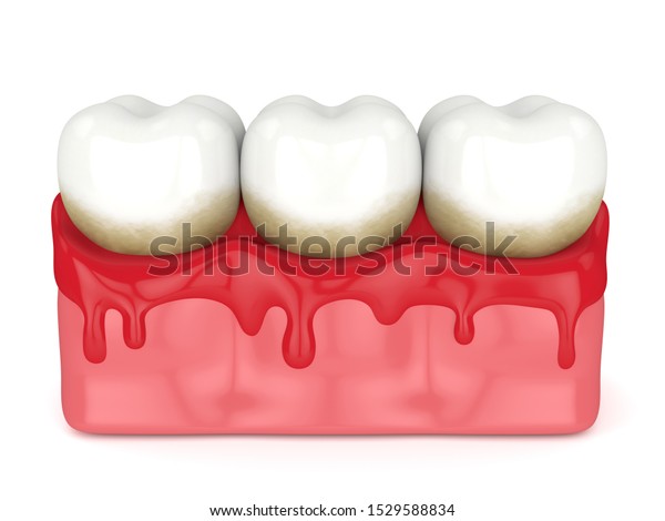 3d Render Teeth Bleeding Gums Over Stock Illustration 1529588834