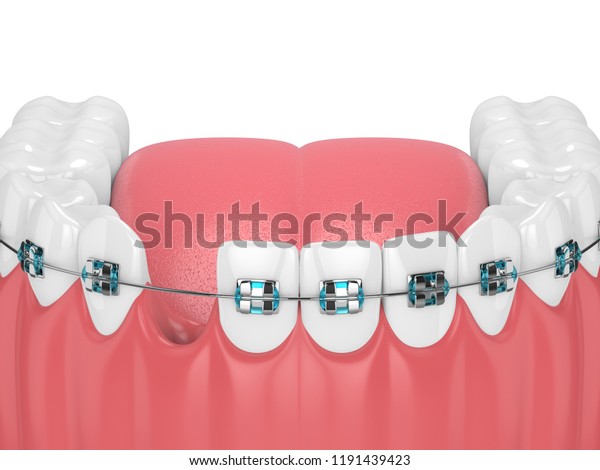 3d Render Teeth Braces Cavity Isolated Stock Illustration 1191439423 ...