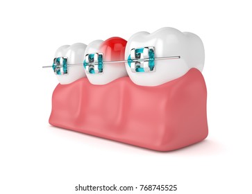 Teeth Braces Alignment Process Medically Accurate Stock Illustration ...