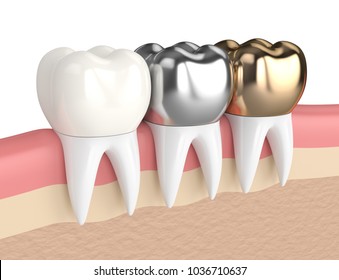 22,962 Golden tooth Images, Stock Photos & Vectors | Shutterstock
