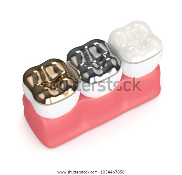 3d Render Teeth Gold Amalgam Composite Stock Illustration 1034467858 ...