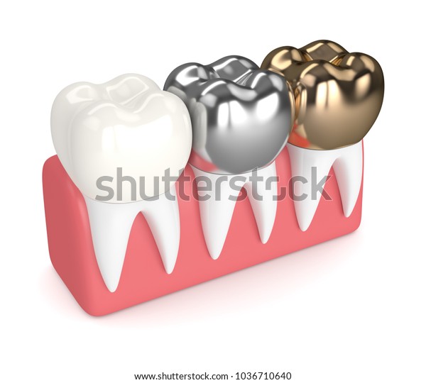 3d Render Teeth Gold Amalgam Composite Stock Illustration 1036710640