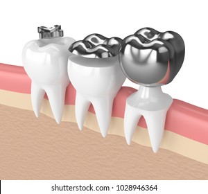 Root Canal Treatment Process 3d Render Stock Illustration 1187006161