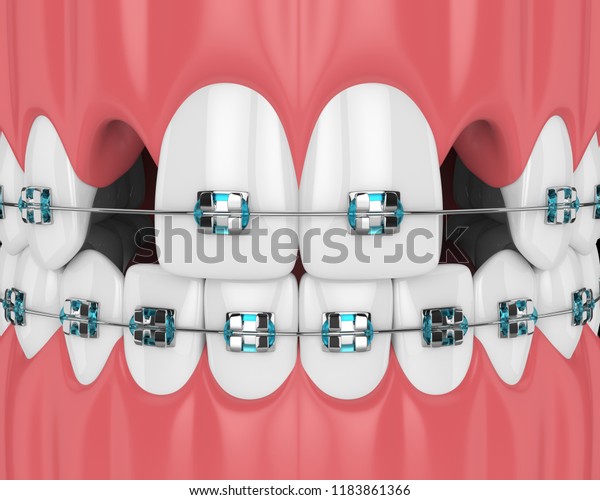 3d Render Teeth Orthodontic Braces Cavities Stock Illustration ...