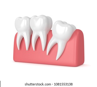 3d Render Teeth Wisdom Crowding Over Stock Illustration 1084949855