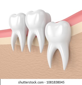 3d Render Teeth Wisdom Vertical Impaction Stock Illustration 1081838045 ...
