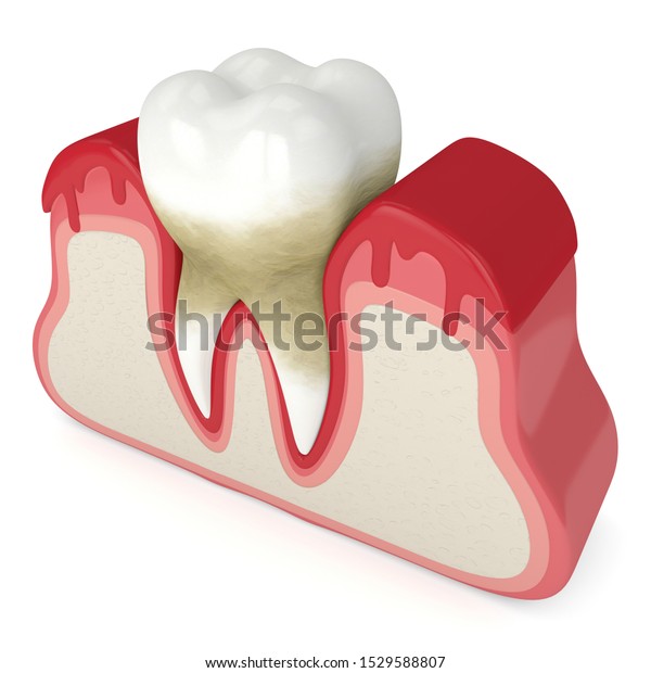 3d Render Tooth Bleeding Gums Over Stock Illustration 1529588807 ...