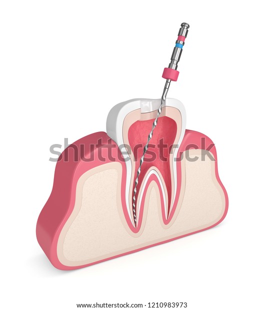 3d render of tooth with endodontic file in gums over white background ...