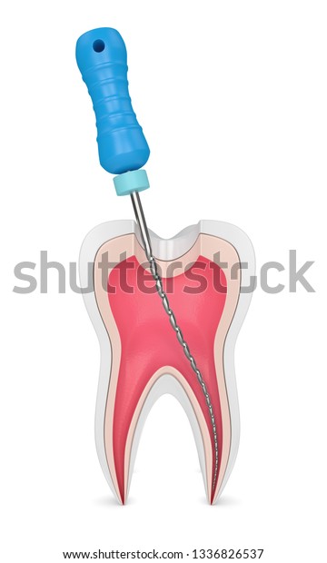 3d Render Tooth Endodontic File Over Stock Illustration 1336826537