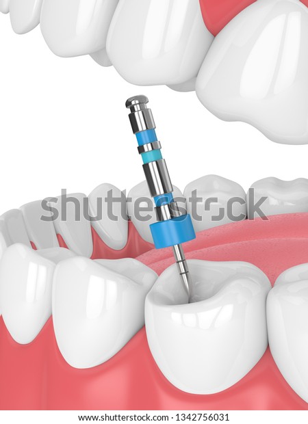 3d Render Tooth Endodontic File Jaw Stock Illustration 1342756031 ...