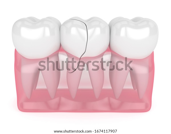 3d Render Of Translucent Gums With Cracked Tooth Over White Background 3d-render-of-translucent-gums-with-cracked-tooth-over-white-background