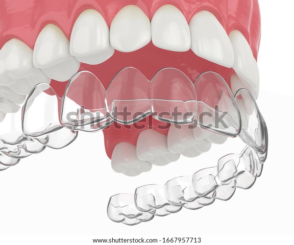 3d Render Upper Jaw Invisalign Removable Stock Illustration 1667957713