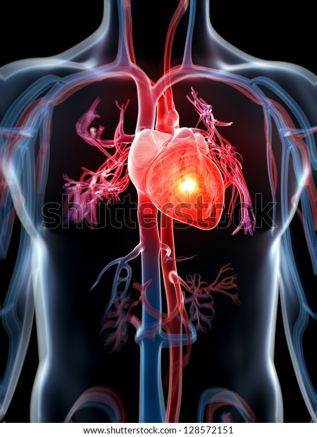 3d Rendered Illustration Heart Attack Stock Illustration 128572151 3d Rendered Illustration Heart Attack Stock Illustration 128572151