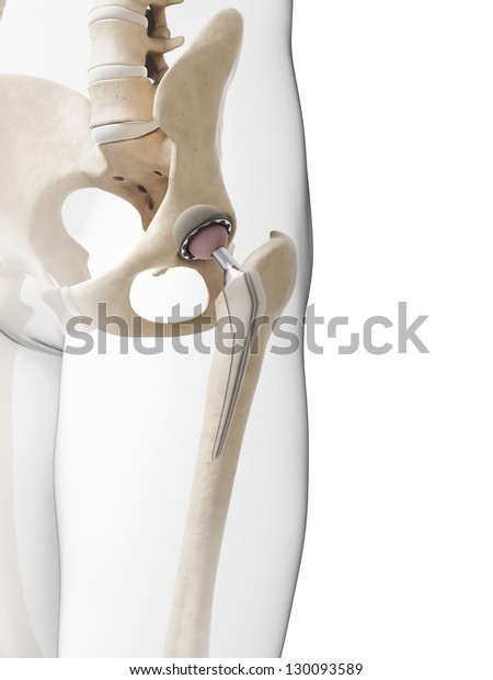 3d Rendered Illustration Hip Replacement Stock Illustration 130093589