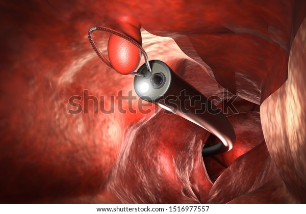 3d Rendering Endoscope Remove Colonic Polyp Stock Illustration ...