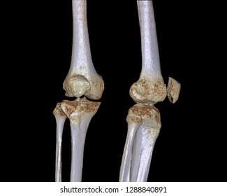 Ct knee Images, Stock Photos & Vectors | Shutterstock