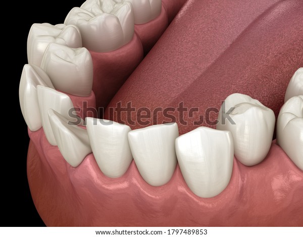 Abnormal Teeth Position Orthodontic Concept Medically Stock ...