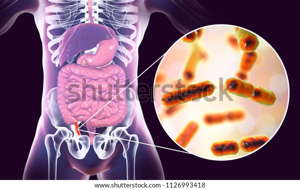 Acute Appendicitis Caused By Bacteria Bacteroides Stock Illustration ...