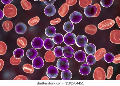 Acute Lymphoblastic Leukemia Bone Marrow Smear Stock Illustration ...