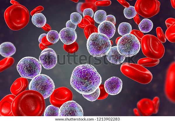Acute Lymphoblastic Leukemia Bone Marrow Smear Stock Illustration ...
