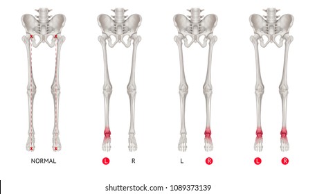 Ilustrasi Stok Valgus Alignment Knockknee Red Highlights On 1073697605 ...