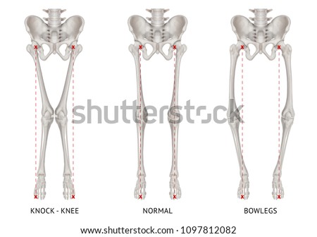 Alignment Types Disease Leg Bone Problem Stock Illustration 1097812082 ...