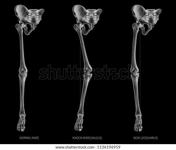 Alignment Types Disease Lower Half Limbs Stock Illustration 1136196959 ...