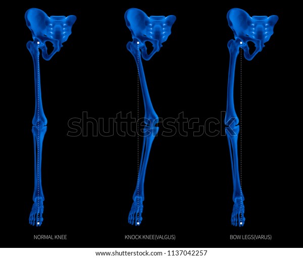 Alignment Types Disease Lower Half Limbs Stock Illustration 1137042257