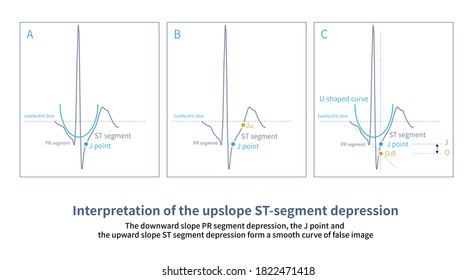 99 St Segment Depression Images, Stock Photos & Vectors | Shutterstock