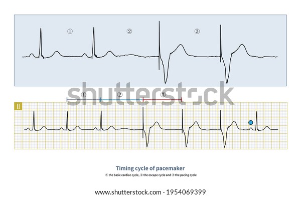 Analyze Ecg Pacemaker We Need Know Stock Illustration 1954069399