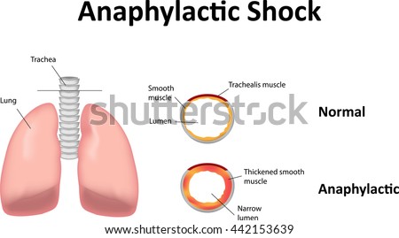 Anaphylactic Shock 스톡 일러스트 442153639 - Shutterstock