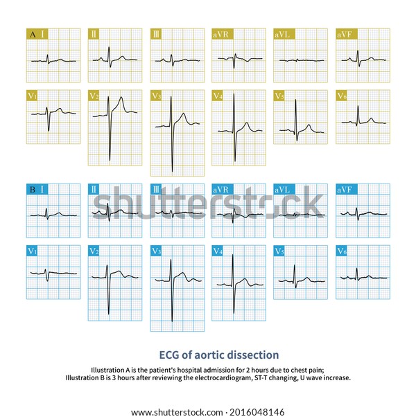 Aortic Dissection Important Differential Diagnosis Acute Stock ...