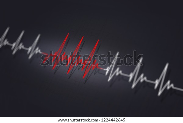 Arrythmia Medical Illustration Heart Irregular Pulsating Stock ... Arrythmia Medical Illustration Heart Irregular Pulsating Stock ...