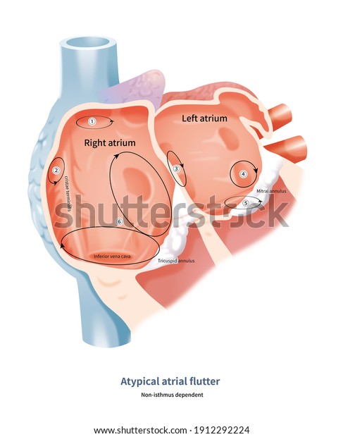 Atypical Atrial Flutter Reentry Loop Can Stock Illustration 1912292224