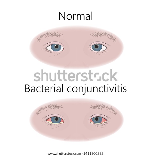 Bacterial Conjunctivitis Infection Comparison Normal Flat Stock ...