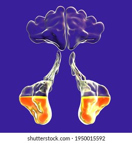 Bilateral Diffuse Maxillary Sinusitis 3d Illustration Stock ...